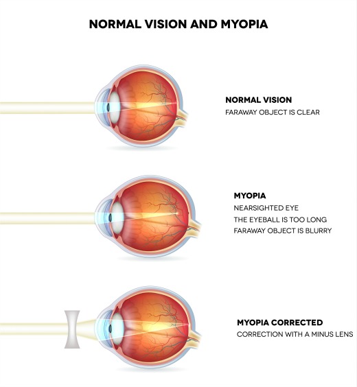 Macular Disease - Types of Retinal Conditions Affecting The Macula